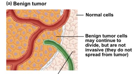 Cancer Flashcards Quizlet