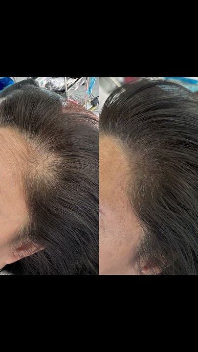 비어있는 헤어라인 때문에 고민인 사람 🖐🏻 Youtube