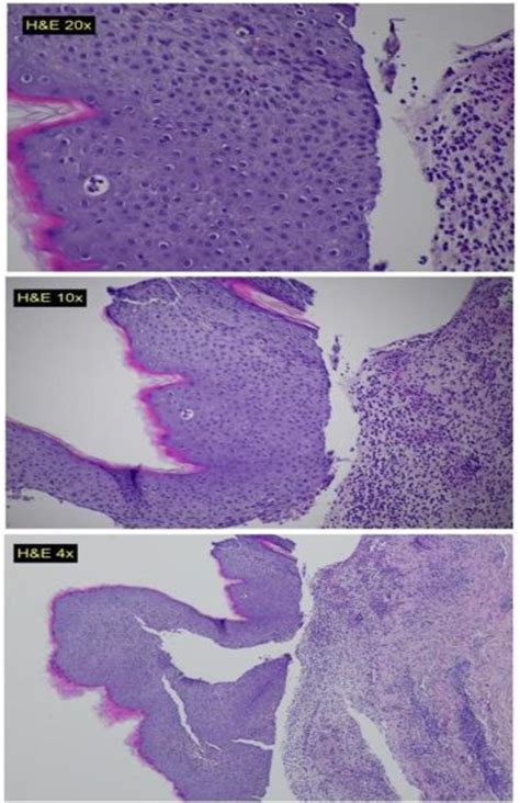 Figure From Bullous Pemphigoid Occurring After Stopping Imatinib Therapy Of Cml Is A
