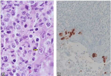 Adenovirus Infection A Infected Cells With Enlarged Amphophilic