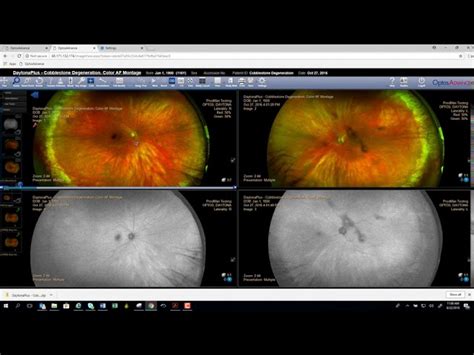 Cobblestone Degeneration