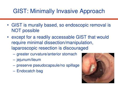Ppt The Surgeons Role In The Management Of Gastrointestinal Stromal