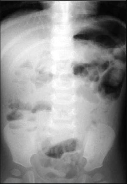 A Erect Abdominal Radiograph Showing Several Air Fluid Levels Download Scientific Diagram