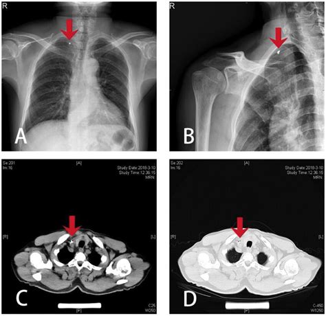 Preoperative Imaging A Frontal Chest Radiograph B Tangential Download Scientific Diagram