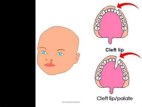 5 Fetal Face Ultrasound Dr Ahmed Esawy Pdf