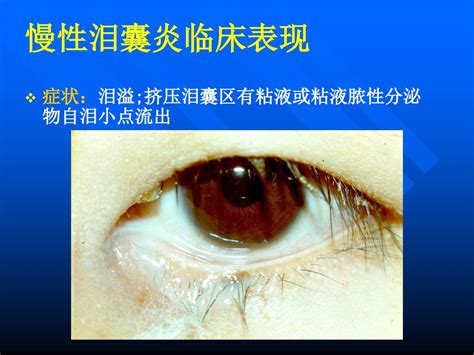 外眼疾病 Ppt Download