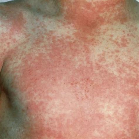 Strep Rash On Chest