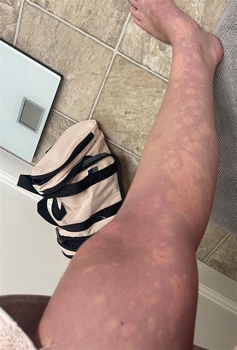 Weird Rash On Legs Rallergy