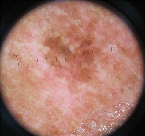 Dermoscopic Evaluation Of Superficial Spreading Melanoma Anais Brasileiros De Dermatologia