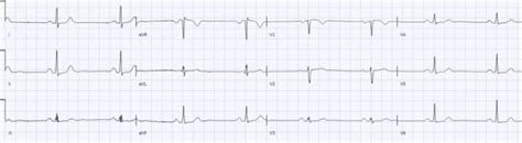 ecg artifact and lead misplacement ecg cases em cases
