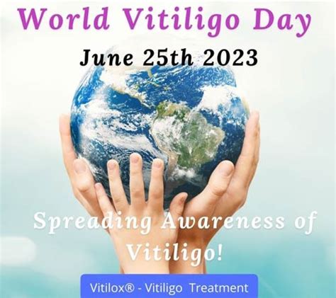 World Vitiligo Day 2023 Vitiligo Treatment Australia