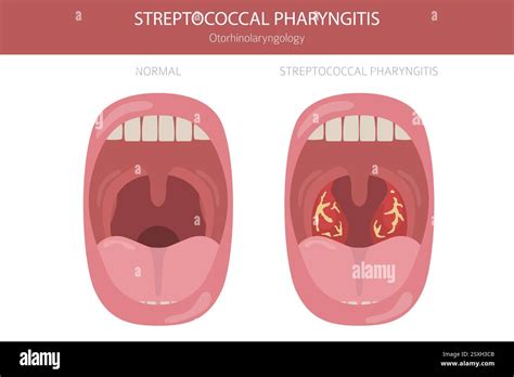 Tonsils And Throat Diseases Streptococcal Pharyngitis Medical Infographic Design Vector