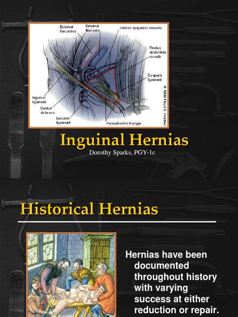 Inguinal Hernia Ppt Medical Specialties Wellness