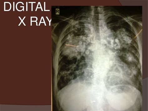 X Ray Egg Shell Calcifiction