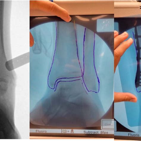 Ap Radiograph Of Right Bicondylar Comminuted Tibial Plateau Fracture