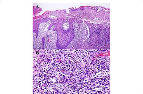 Biopsy Results Of Case 2 Upon Initial Presentation A At Medium Power Download Scientific