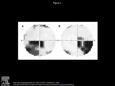 Inferior Temporal Visual Field Defect