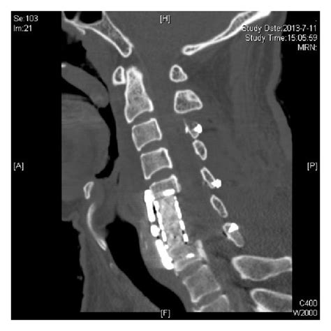 Postoperative Ct Scan Sagittal Reconstruction A C3c7 Laminoplasty And