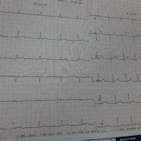 Ecg Shows Repolarization Abnormalities Leads Ii Avf And Iii Table 1