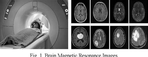 Figure 1 From Pioneering Early Parkinsons Disease Detection With Deep