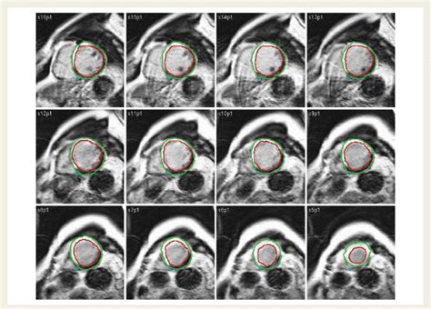 Short Axis Slices Obtained With Contrast Enhanced Magnetic Resonance