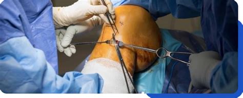 Acl Reconstruction Surgery Dubai Expert Acl Surgeons
