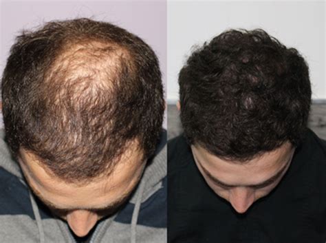 Hairline International