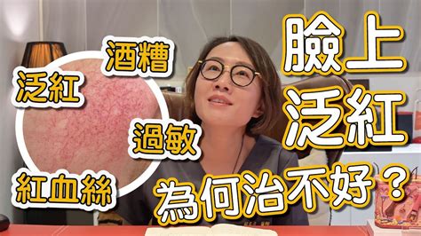 臉上紅紅是過敏酒糟性皮膚炎這一些症狀可以預防嗎 YouTube
