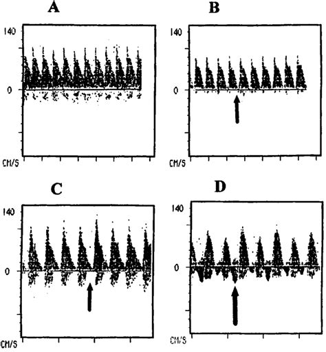 Tcd Waveforms Recorded Before A And After B Residual Aortic Valve