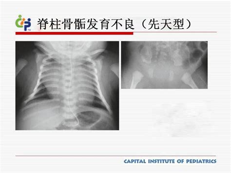 儿童跟骨骨骺x线图片 小儿肱骨骨骺线图片 儿童肱骨骨骺正常线 大山谷图库