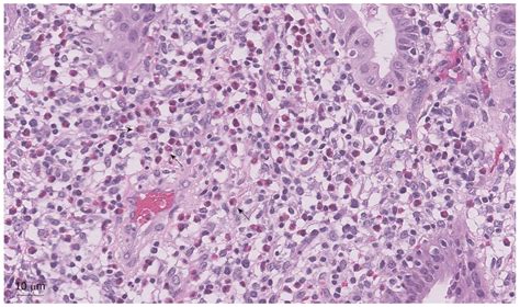 Eosinophilic Cholangitis A Case Report Of Diagnostically Challenging Eosinophilic Infiltrative