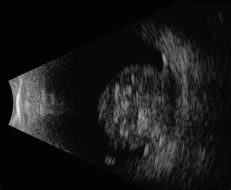 Review Of Retinoblastoma American Academy Of Ophthalmology