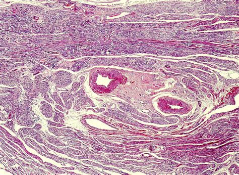 Uterine Fibroid Light Micrograph Stock Image C050 8395 Science