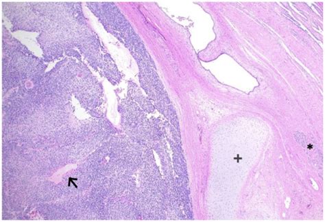 Transformed Testicular Teratoma To Embryonic Type Neuroectodermal Tumor With Metastasis To