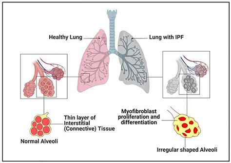 Emerging Drug Delivery Strategies For Idiopathic Pulmonary Fibrosis
