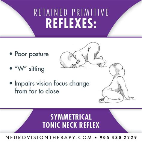 What Is The Symmetric Tonic Neck Reflex Ixxliq