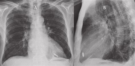 Chest Radiography A Face B Profile After Successful Implantation