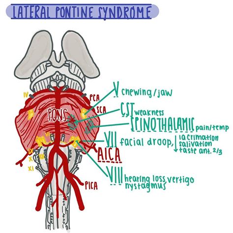 Medial Pontine Syndrome