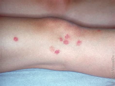 Close Up Pictures Of Bedbug Bites And Signs To Watch For Goodrx