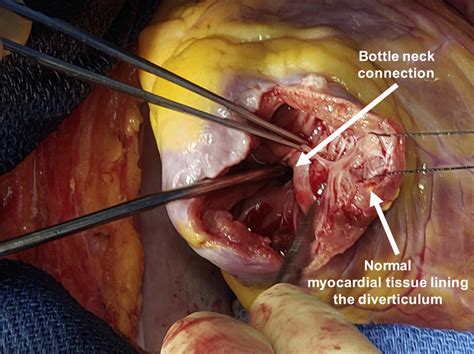 Intraoperative Surgical Specimen Of The Diverticulum Demonstrating