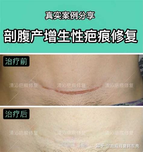 剖腹产后的疤痕有什么办法能去掉呢？ 知乎
