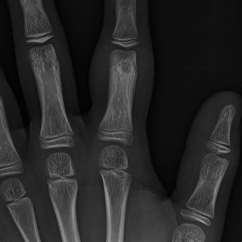 Ap A And Lateral B Plain Radiographs Show A Well Defined Exophytic Download Scientific