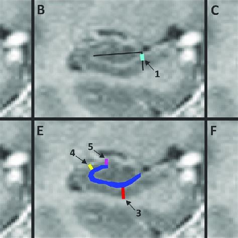 Segmentation Of Hippocampal Subfields Using In Vivo Mri Subfield