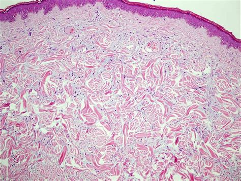 Photoletter To The Editor Cutaneous Myxoid Fibroblastoma Abstract