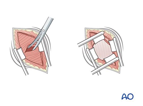 Minimally Invasive Transpsoas Approach L2 L4