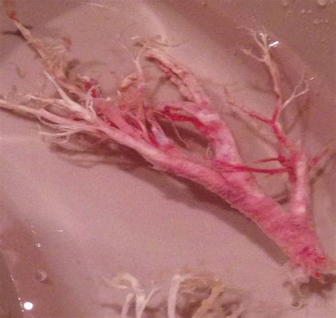 Plastic Bronchitis Causes Symptoms Diagnosis And Treatment