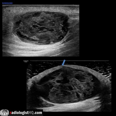 Epidermal Inclusion Cysts On Ultrasound Rradiology