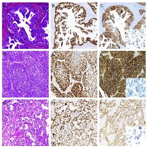 The Relationship Between Pd L1 Expression And Her2 Status In Gastric Download Table