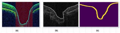 A Oct Image B Processed Oct Image C Extracted Ilm Layer Download