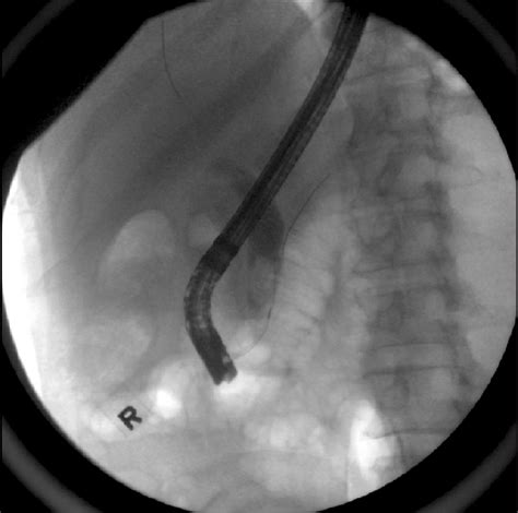 Cholangiogram Showing A Persistent Cbd Stricture Download Scientific